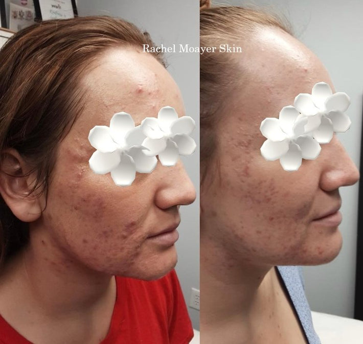 Before & After – Rachel Moayer Skin