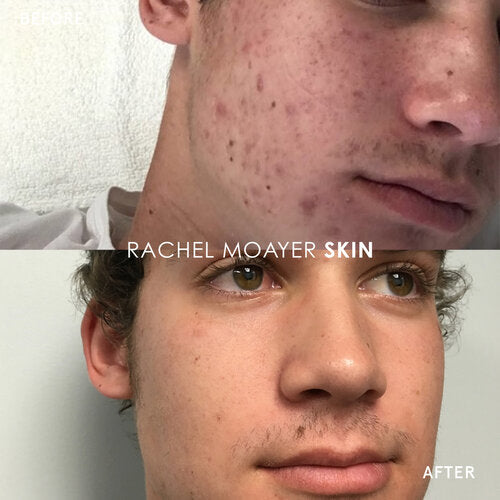 Before & After – Rachel Moayer Skin
