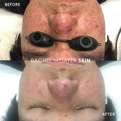 Before & After – Rachel Moayer Skin